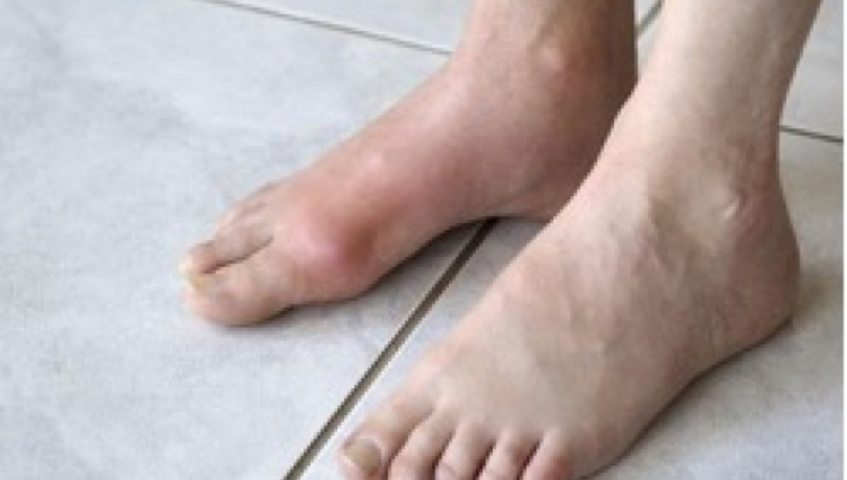 Ουρικό οξύ: Ποια είναι τα ύπουλα συμπτώματα