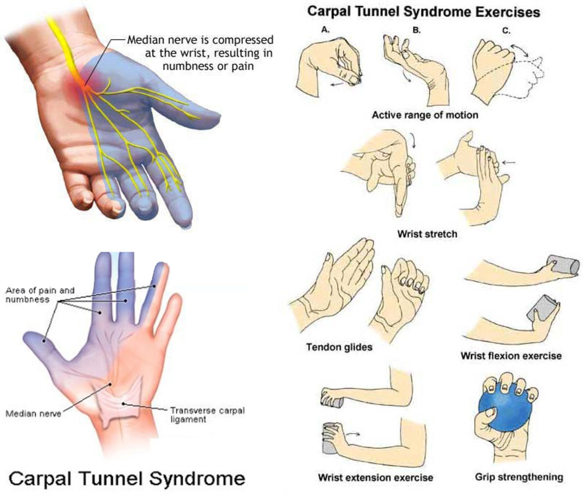 Σύνδρομο καρπιαίου σωλήνα: Ποια δάχτυλα επηρεάζονται - Τι ασκήσεις να ...