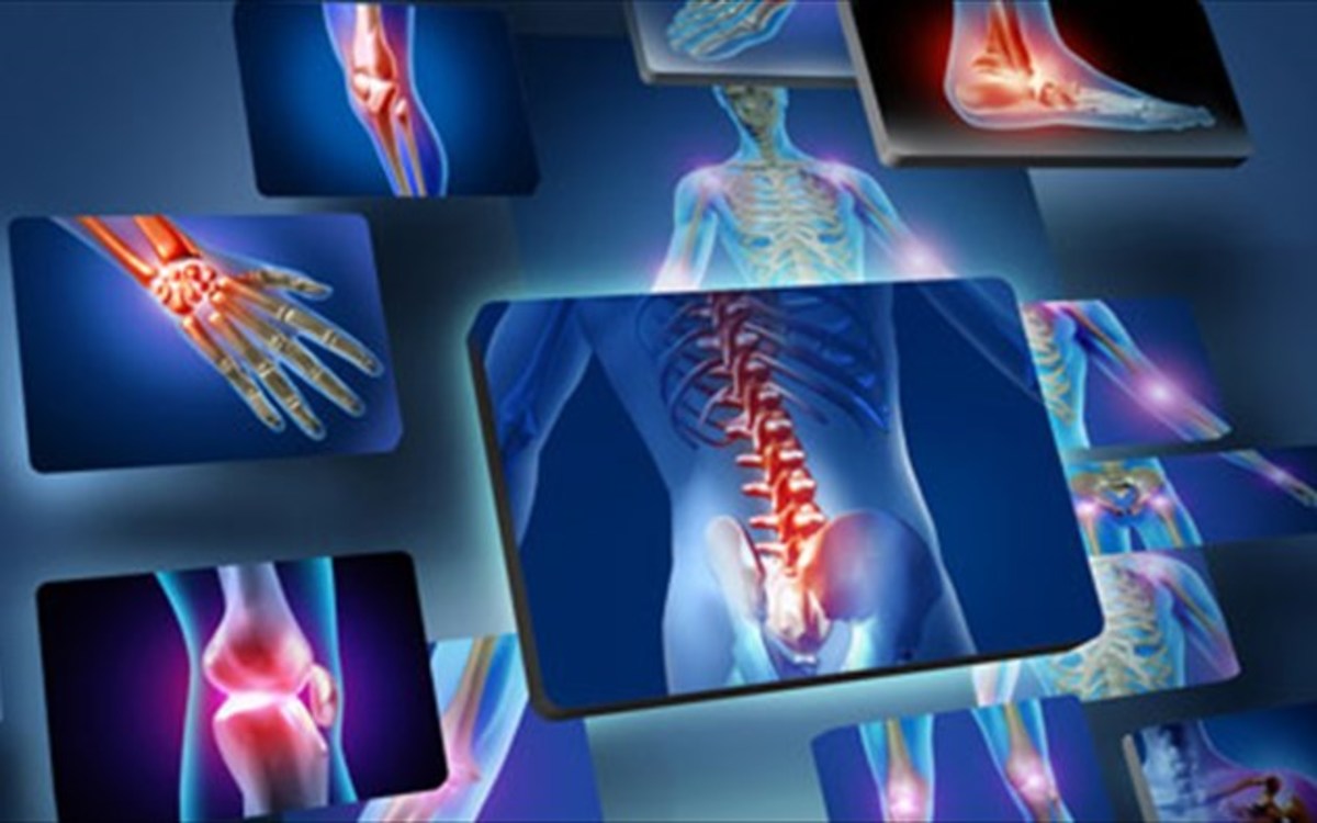 Η οστεοπόρωση είναι η "σιωπηλή επιδημία" που πλήττει την σπονδυλική στήλη