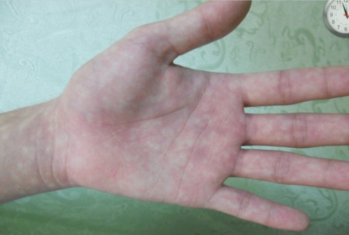 Η ηπατική νόσος μπορεί να αποκαλυφθεί με κηλίδες Bier στο δέρμα: Πώς ...