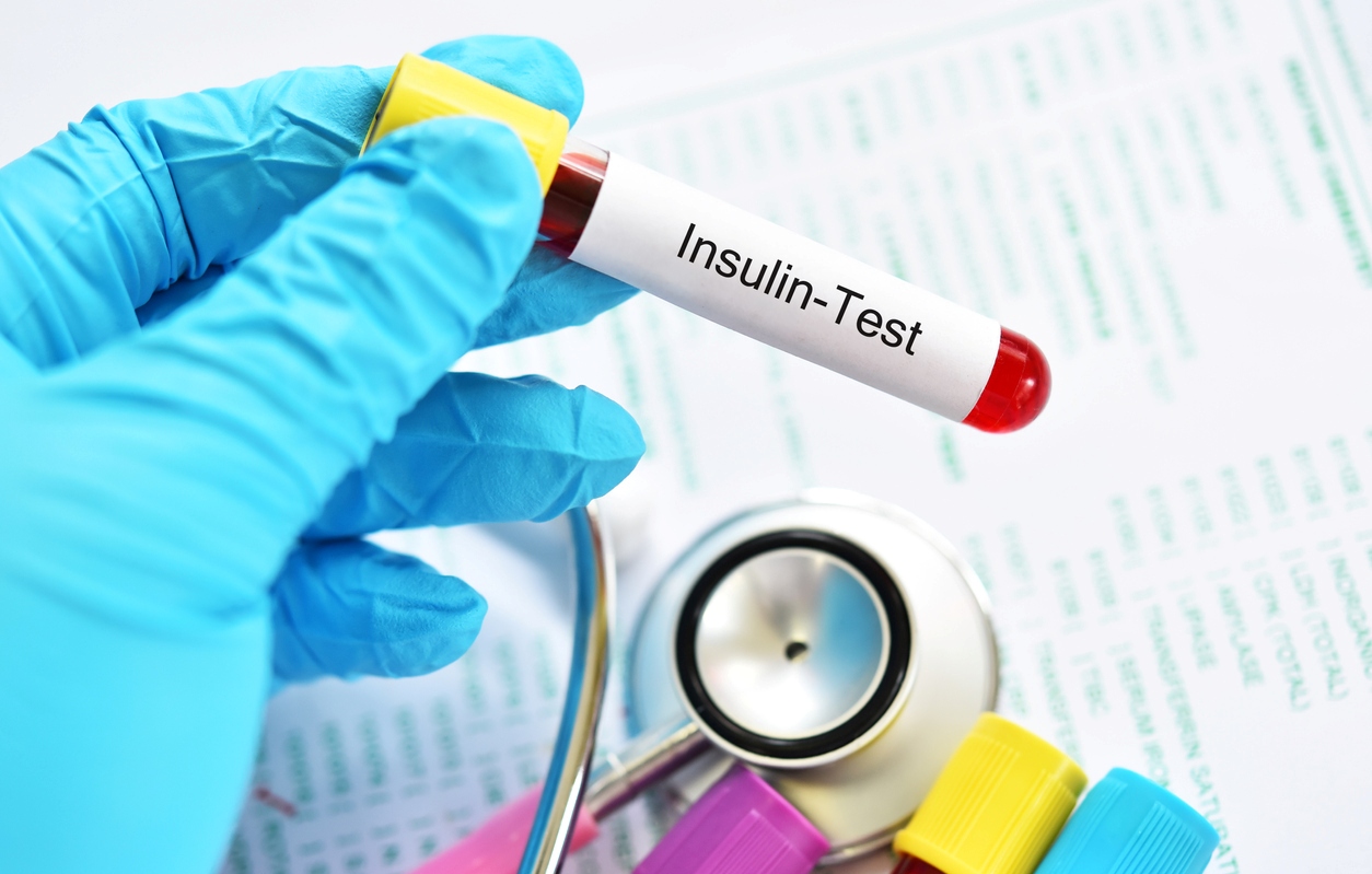 Τα υψηλά επίπεδα ινσουλίνης σχετίζονται άμεσα με τον καρκίνο του παγκρέατος